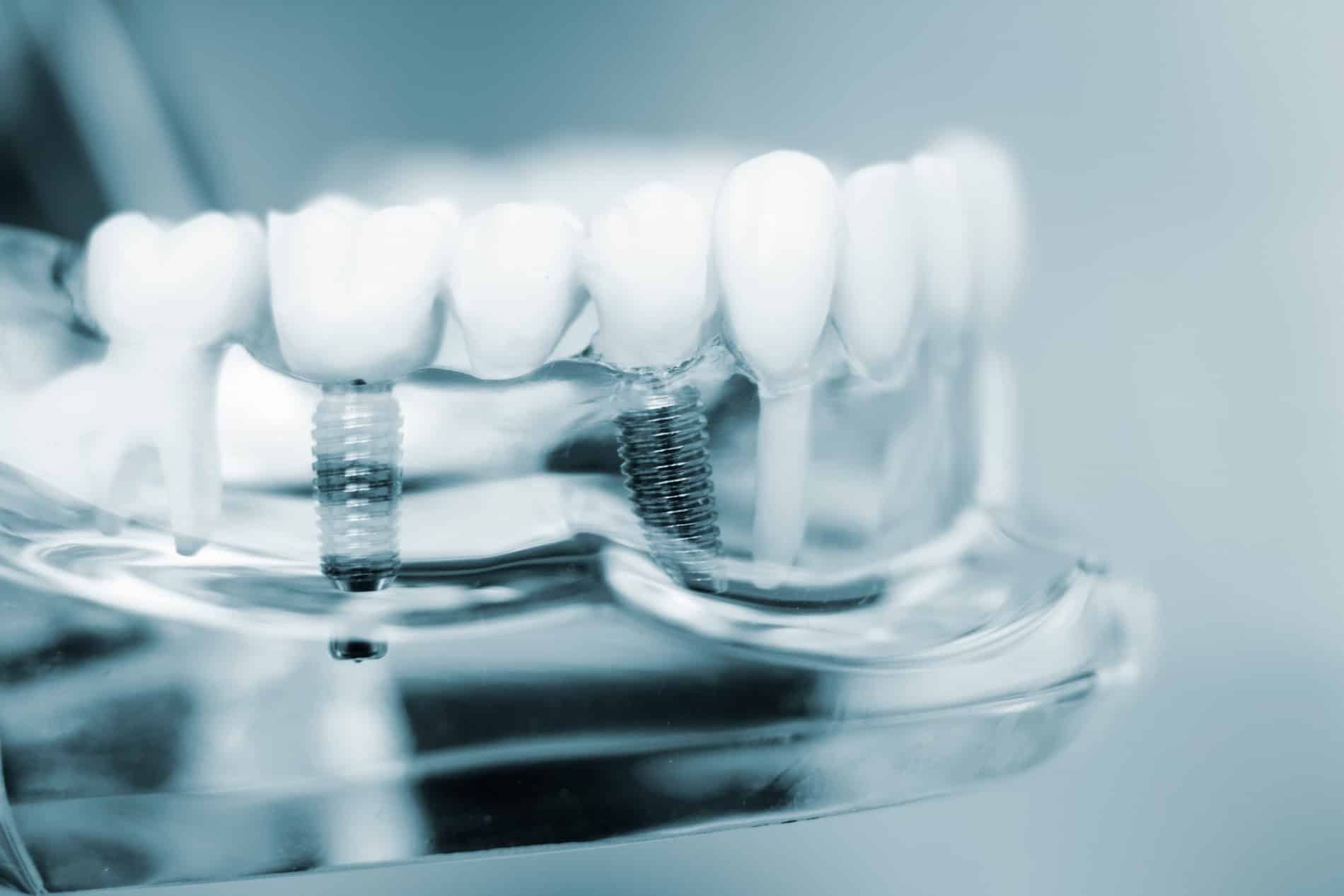 Common All-on-X Dental Implant Problems & Solutions in Rincon GA