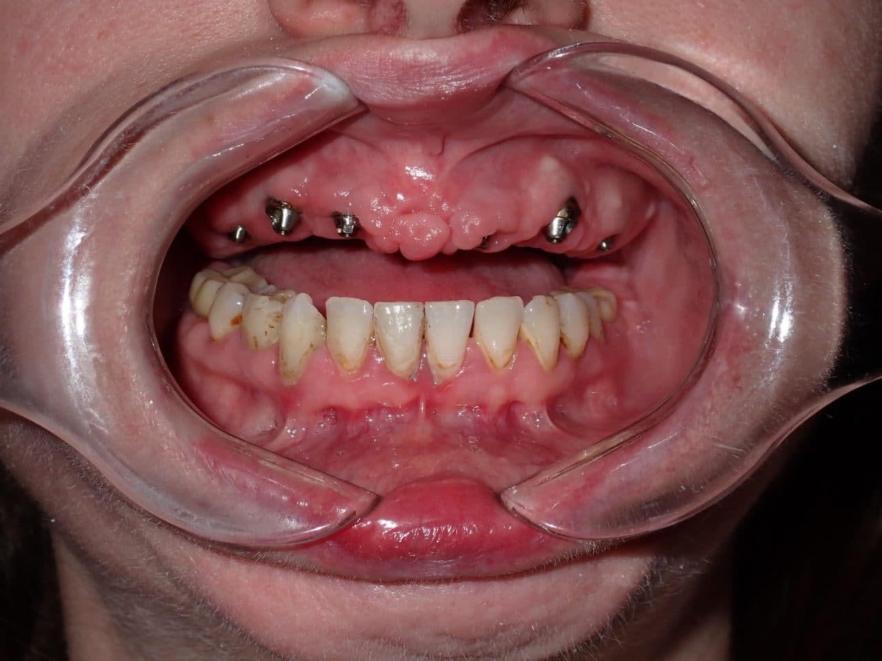 Full Arch Restoration Correction in Rincon, GA - C.C. Transformation