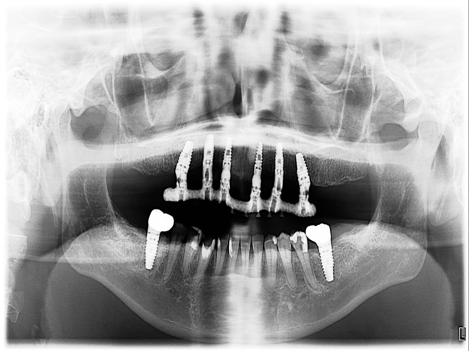 Full Arch Restoration Correction in Rincon, GA - C.C. Transformation